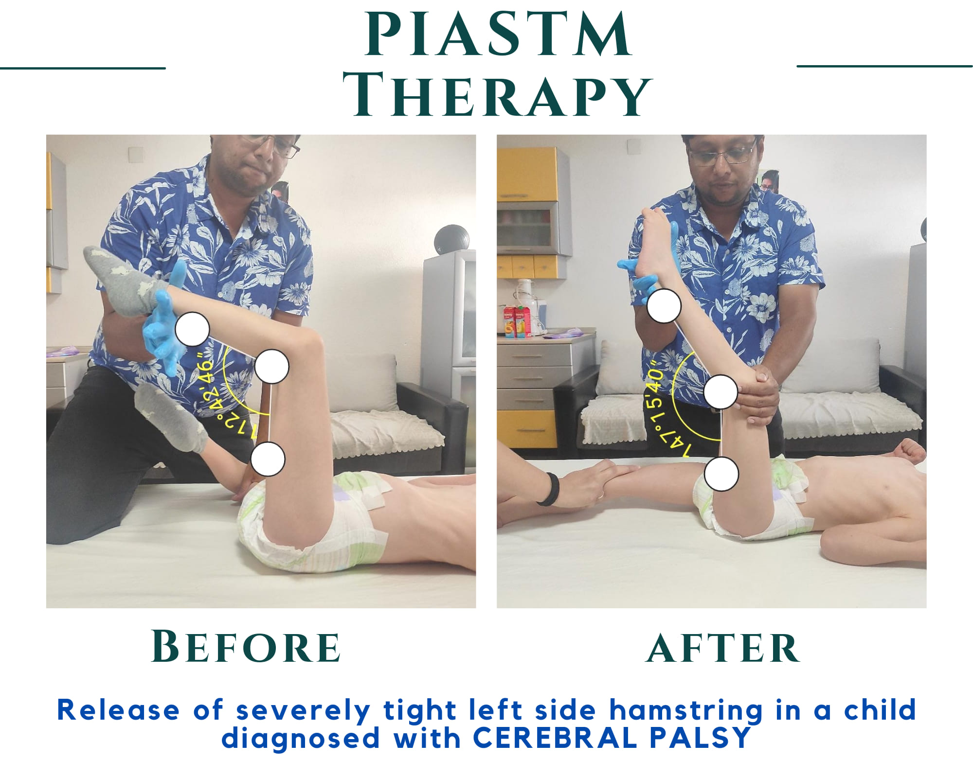 PIASTM : A Revolutionary Therapy For Children Diagnosed With Cerebral ...